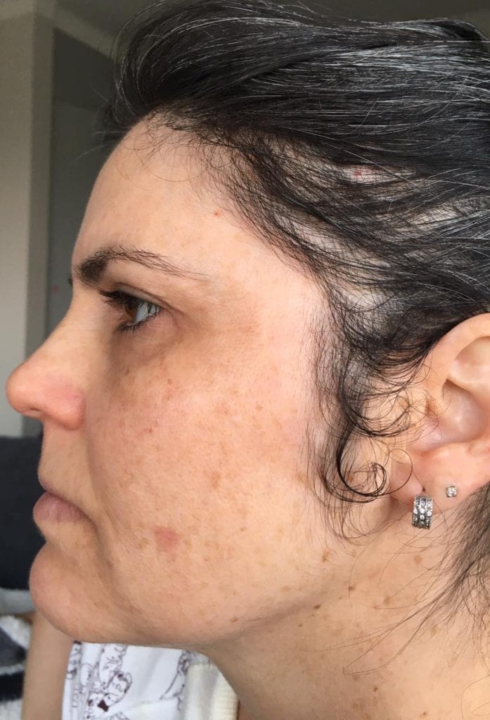 Fibroblast Plasma - Naturally Beautiful Skin Rejuvenation