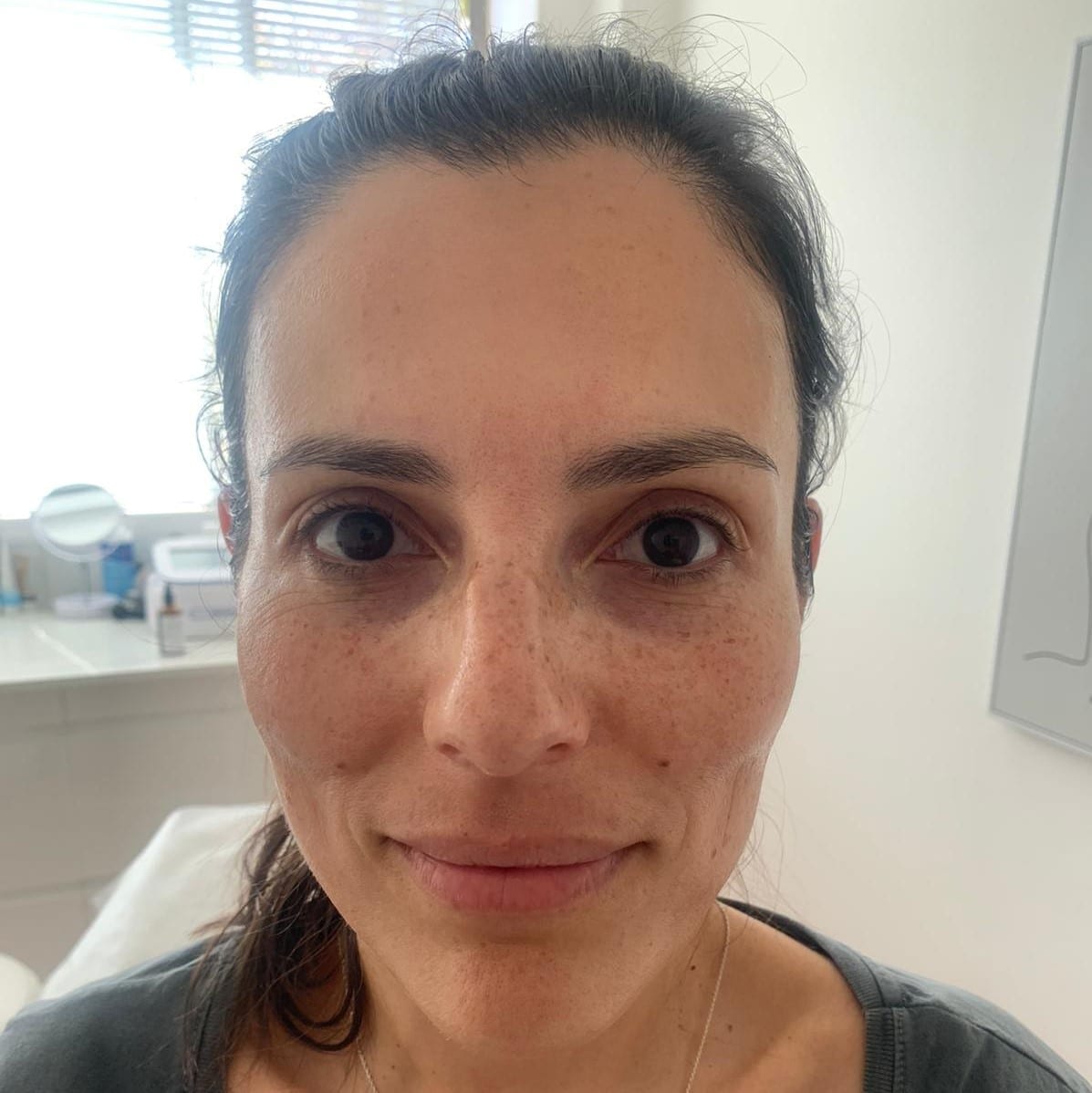 Fractional RF - Naturally Beautiful Skin Rejuvenation